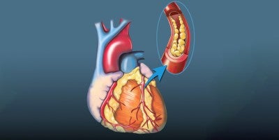 Cardiac Catheterization Restores Blood Flow to Cancer Survivor’s Heart