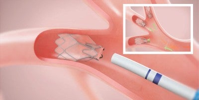 Zephyr Valves Opening Up Treatment Options for People With COPD