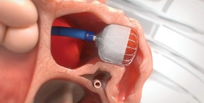 Lehigh Valley Heart and Vascular Institute is First in the Region to ...