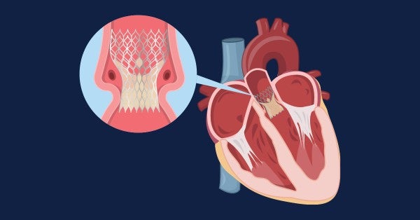 Transcatheter Aortic Valve Replacement (TAVR) | Lehigh Valley Health ...