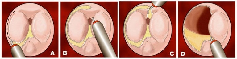 HoLEP | Lehigh Valley Health Network
