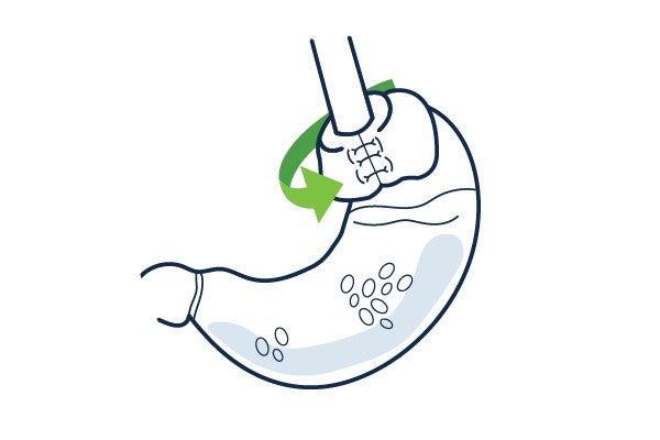 Acid Reflux Surgery | Lehigh Valley Health Network