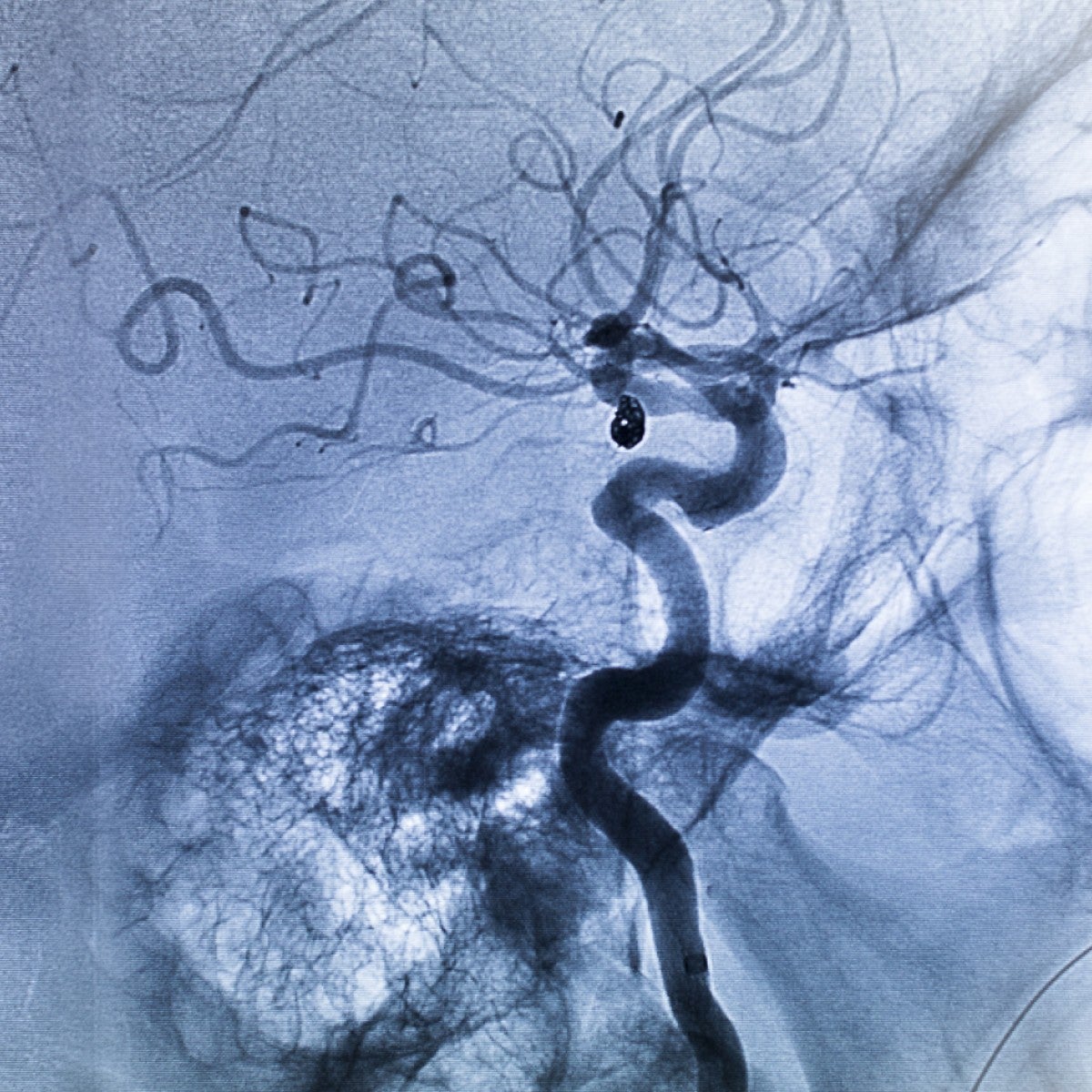 Get With The Guidelines Stroke Gold Plus