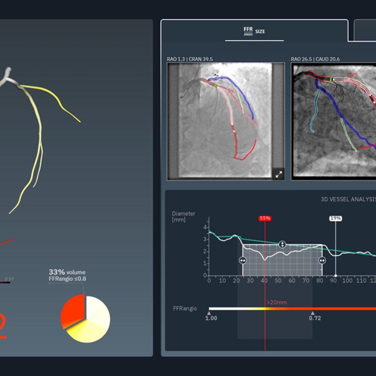 New Chapter in Heart Care: Angiograms Using AI and Science | Lehigh ...
