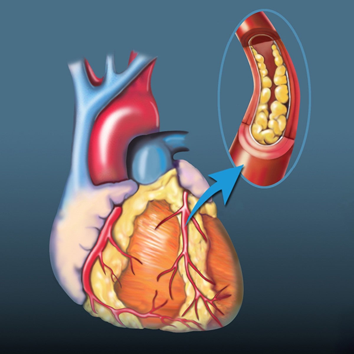 Cardiac Catheterization Restores Blood Flow to Cancer Survivor’s Heart ...