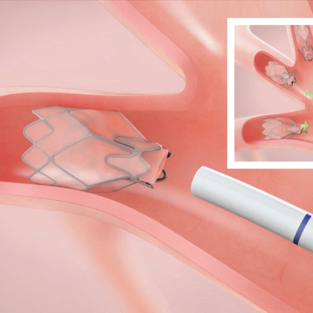 Zephyr Valves Opening Up Treatment Options for People With COPD