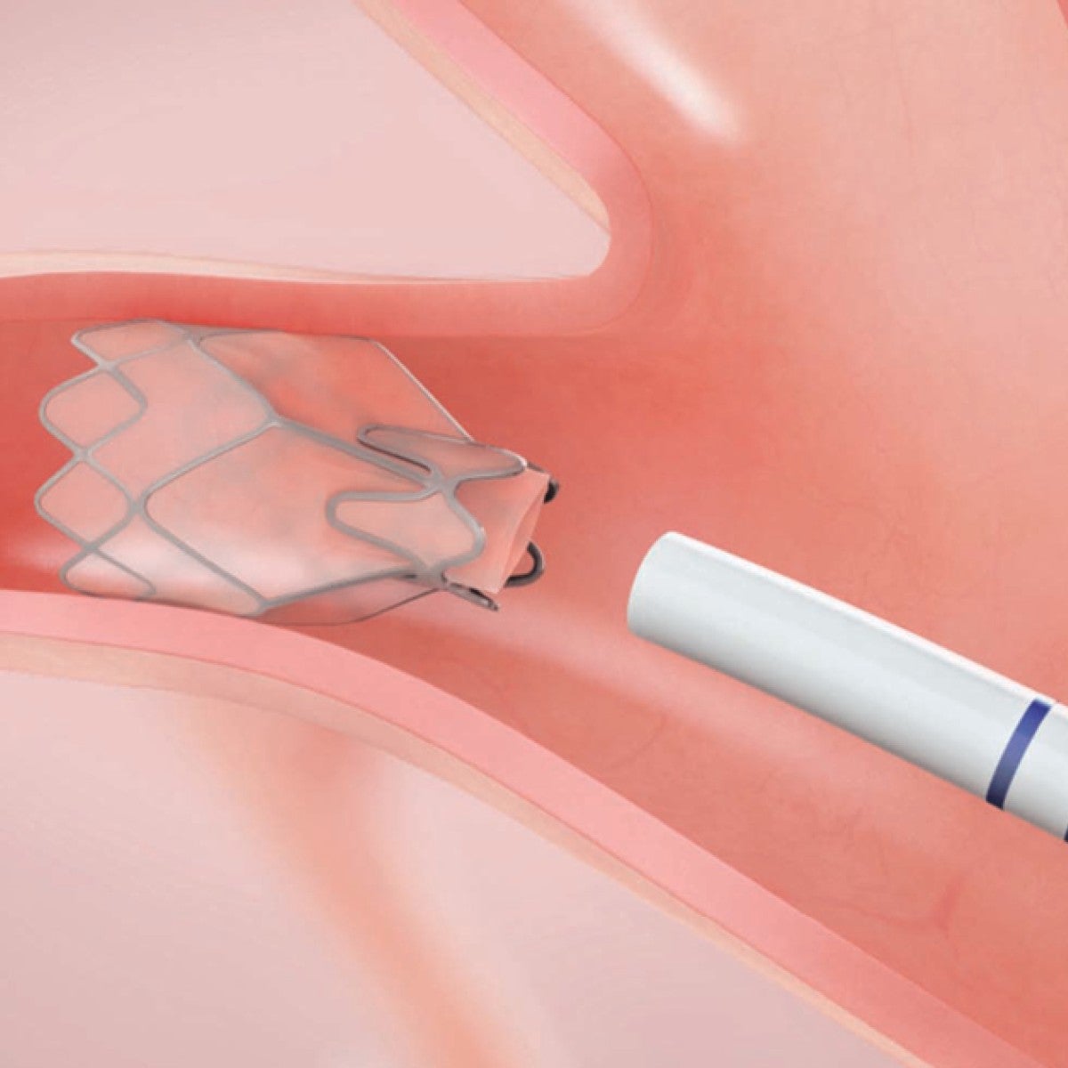 Minimally Invasive Lung Procedure Leads to a Breath of Fresh Air ...