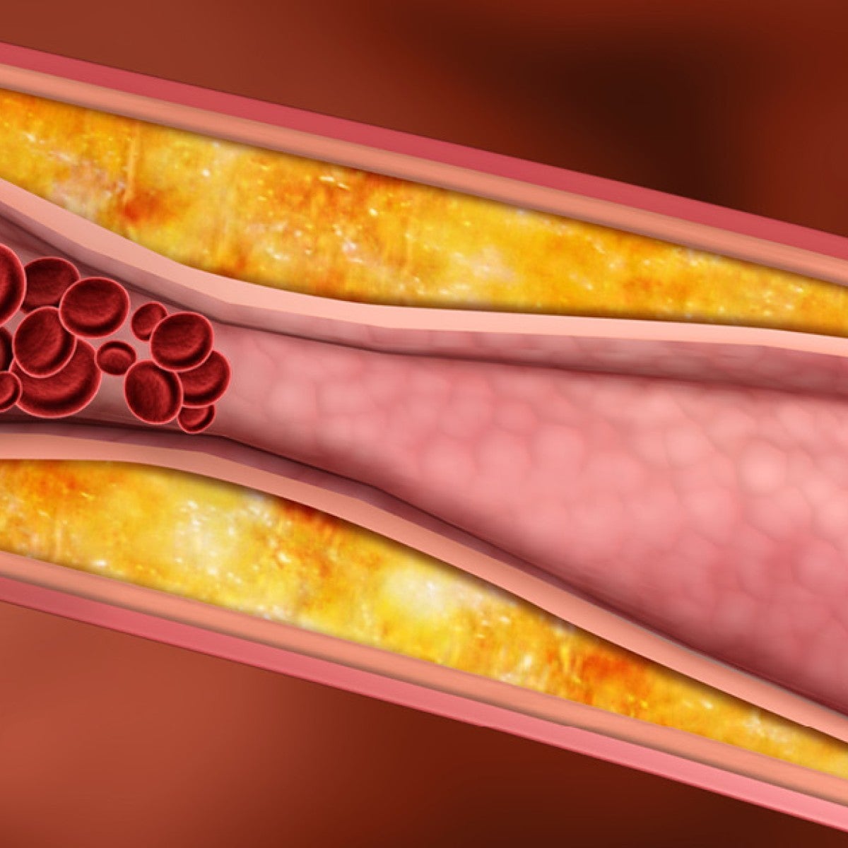 Advanced Procedure to Open Fully Blocked Coronary Arteries a Game ...