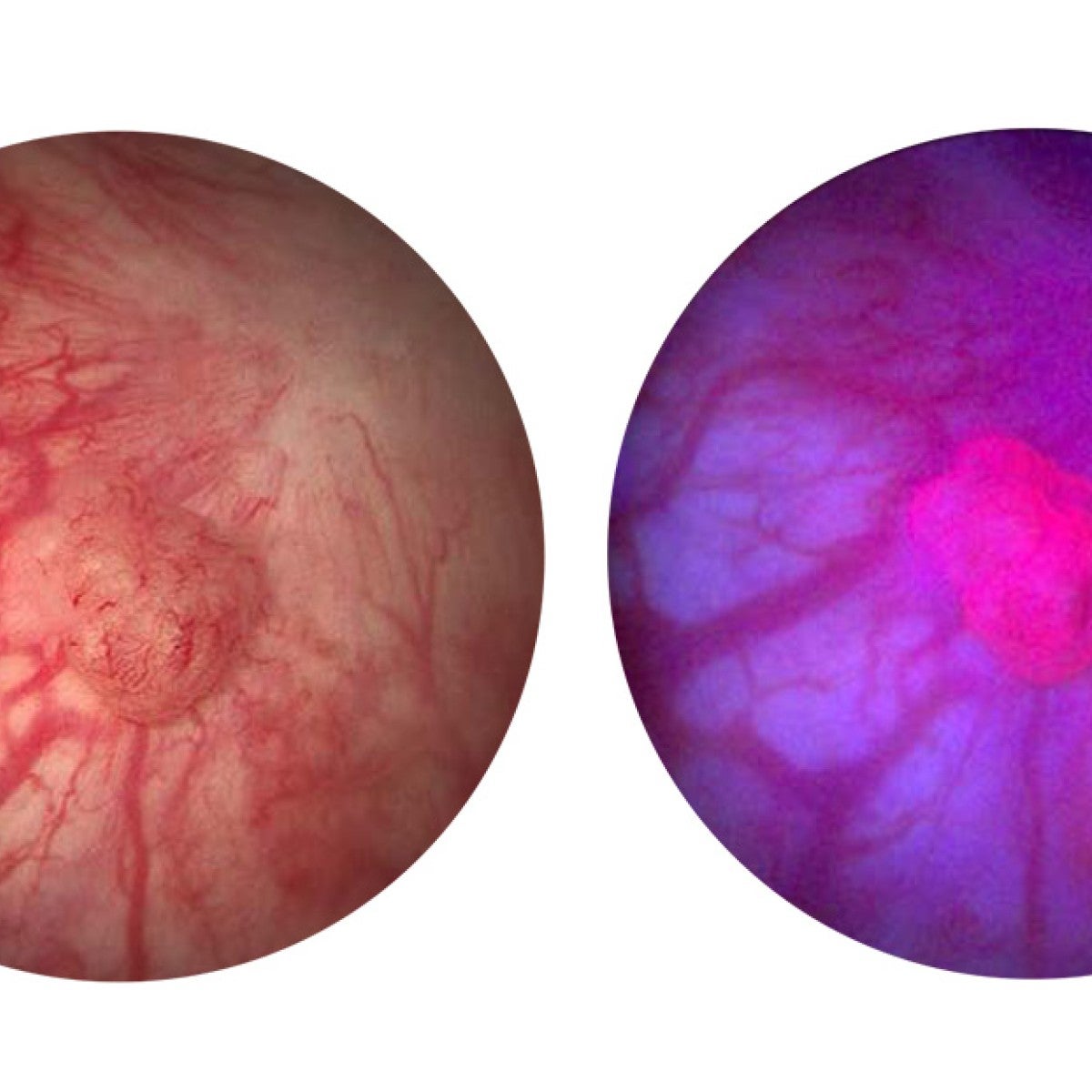 Blue Light Special: A Revolution in Bladder Cancer Treatment | Lehigh ...