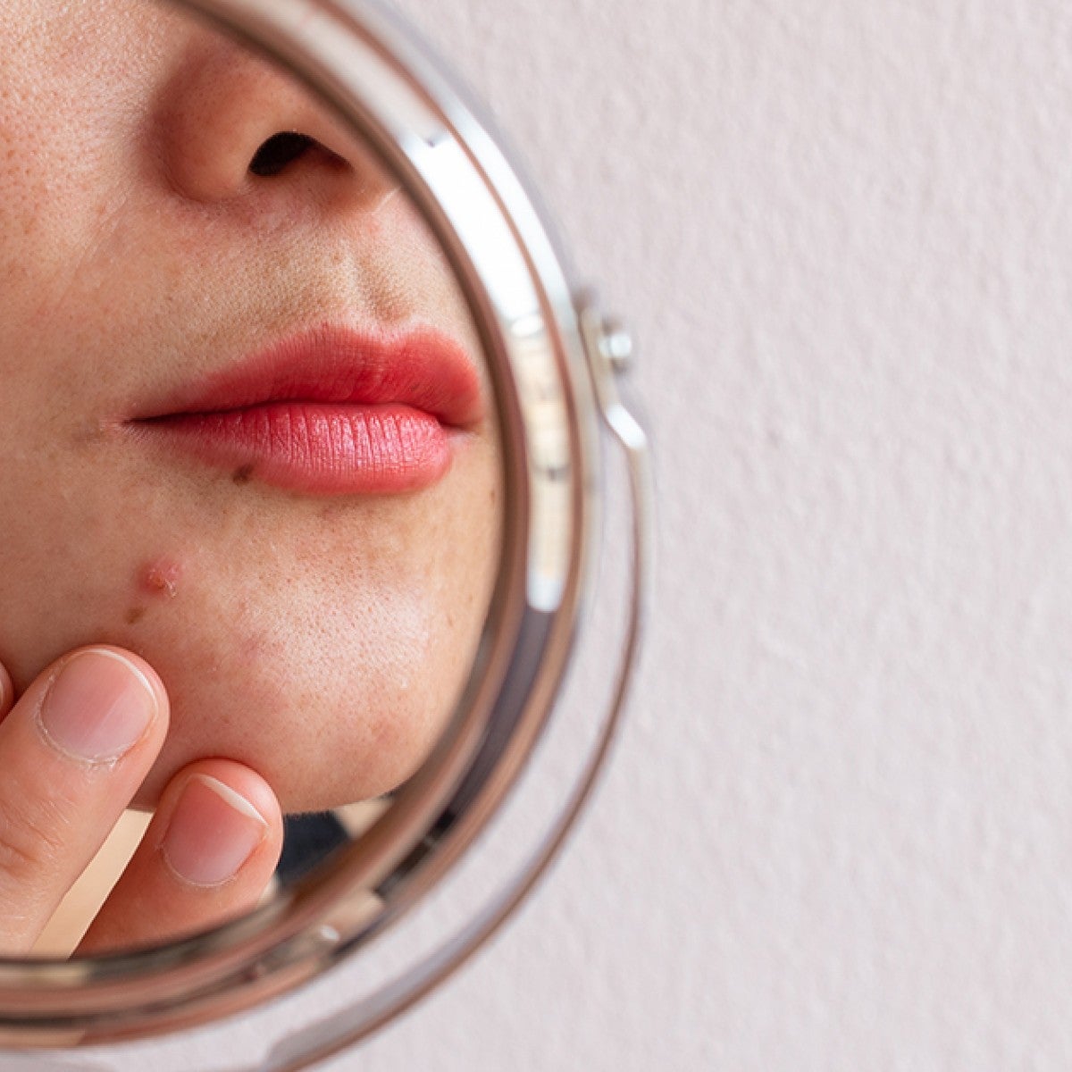 Acne: Not Just for Teens | Lehigh Valley Health Network