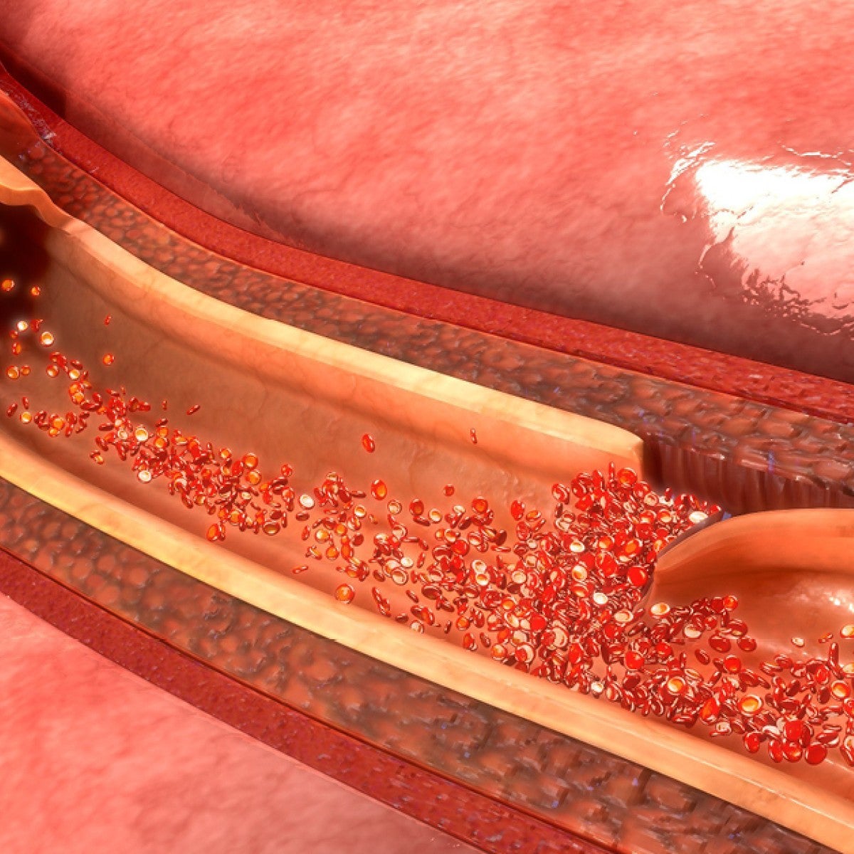 SCAD: The Under-the-Radar Heart Problem | Lehigh Valley Health Network