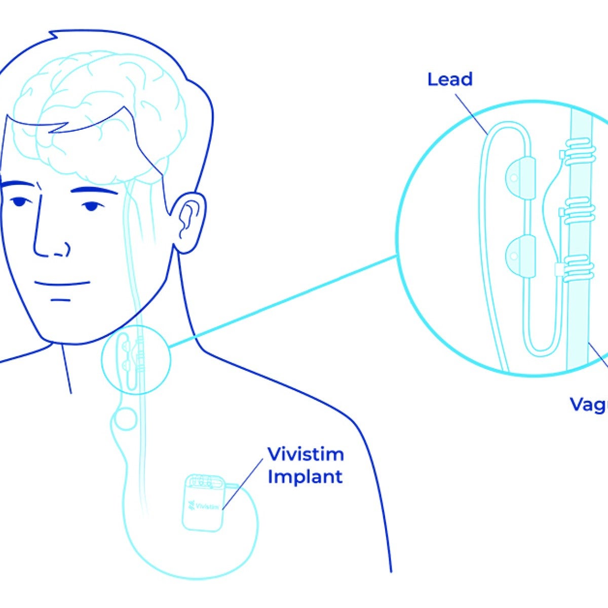 Stroke Patients Increase Upper Limb Function Using Breakthrough ...