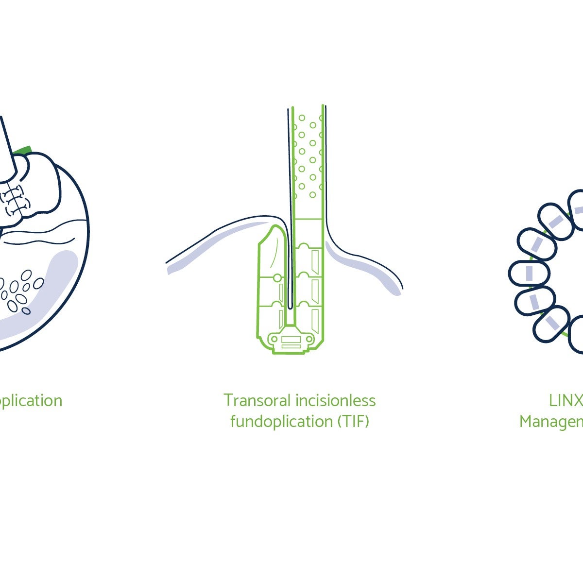 Minimally Invasive Reflux Procedures Available Across Regions | Lehigh ...