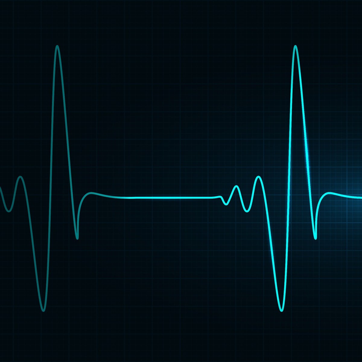 New EKG Screening Program Identifies People at Risk for Hypertrophic ...